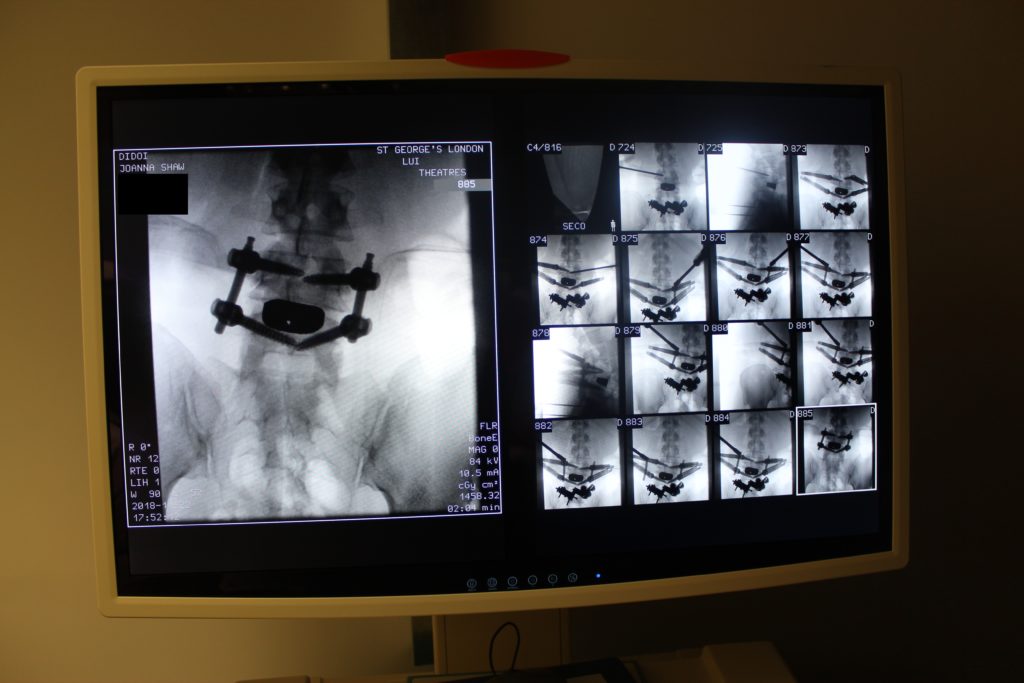 New spinal navigation technology used at St George’s for the first time ...