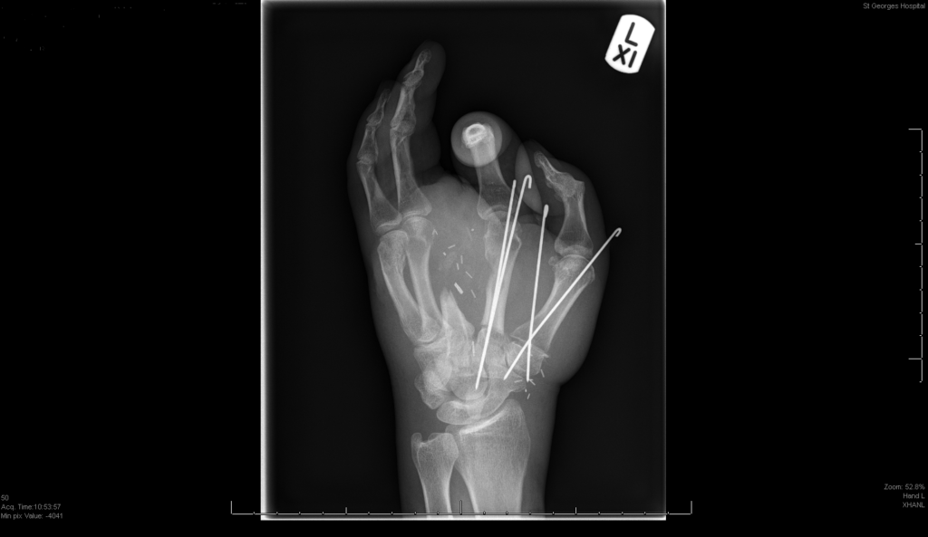 Surgeons save man’s hand after seventeen hours of surgery - St George's ...